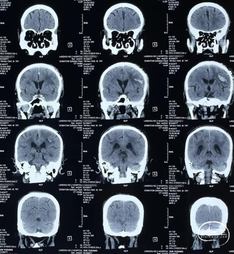 中央区脑出血小骨窗开颅经额下沟神经内镜下血肿清除术 - 脑医汇