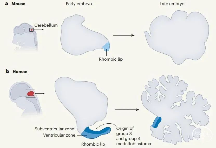 Nature丨致命脑肿瘤有希望预防了！同日两篇《自然》，揭开大脑发育埋下的肿瘤根源 - 脑医汇 - 神外资讯 - 神介资讯