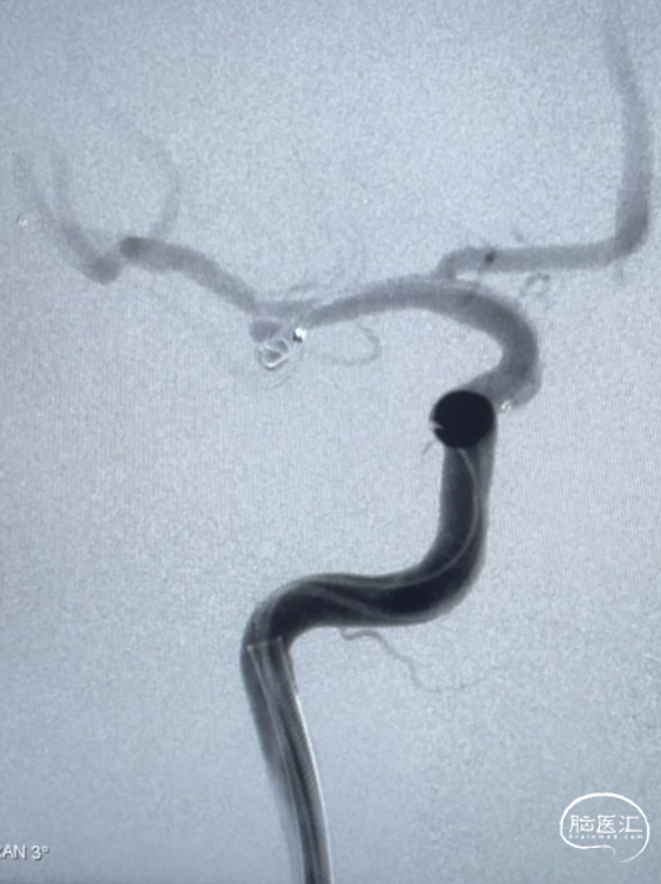 Atlas病例集 | 何黎明：“以柔克刚，不畏迂曲”——支架辅助栓塞迂曲MCA分叶状动脉瘤 - 脑医汇