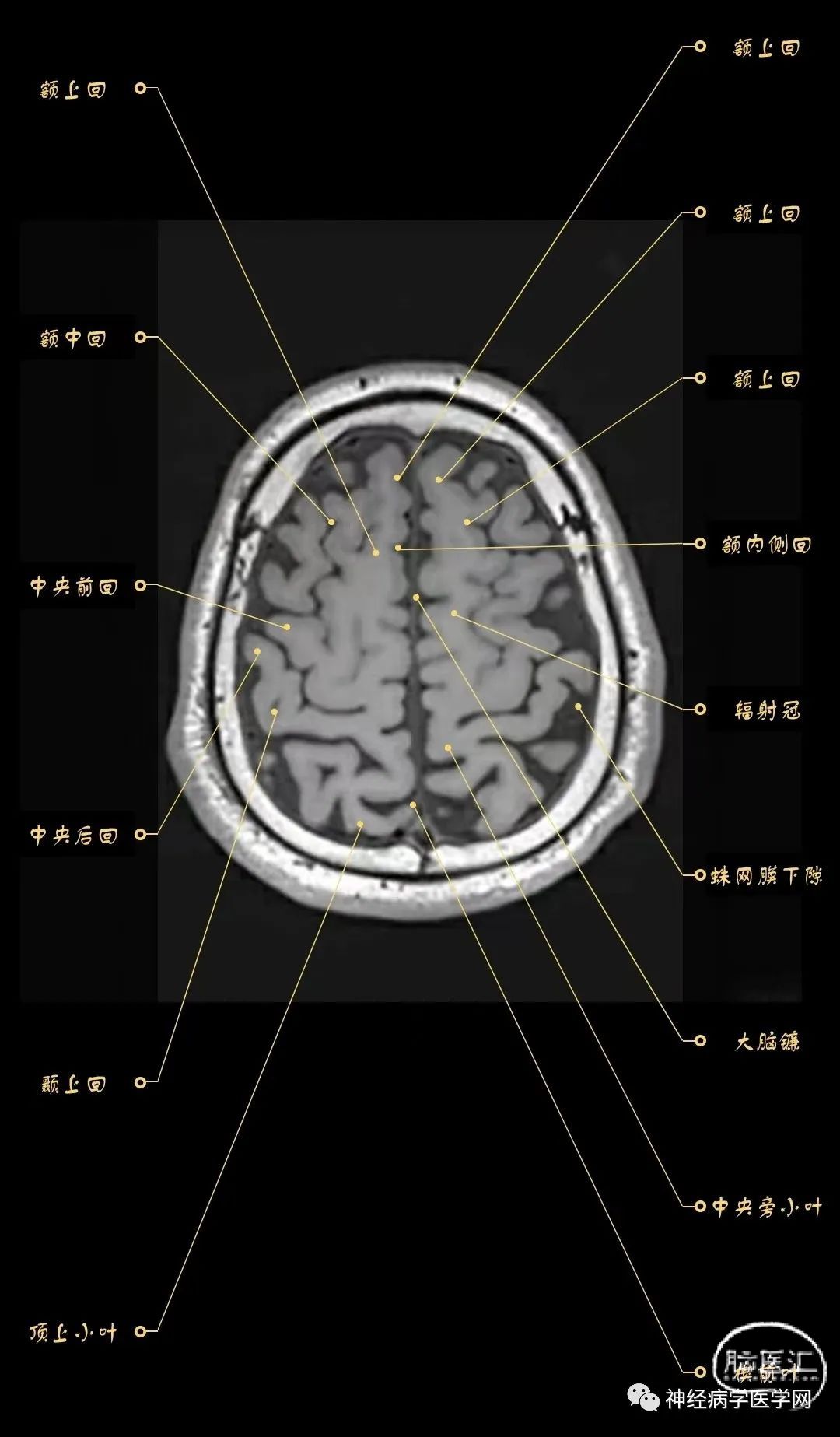 高清颅脑MRI最全轴位影像解剖 - 脑医汇
