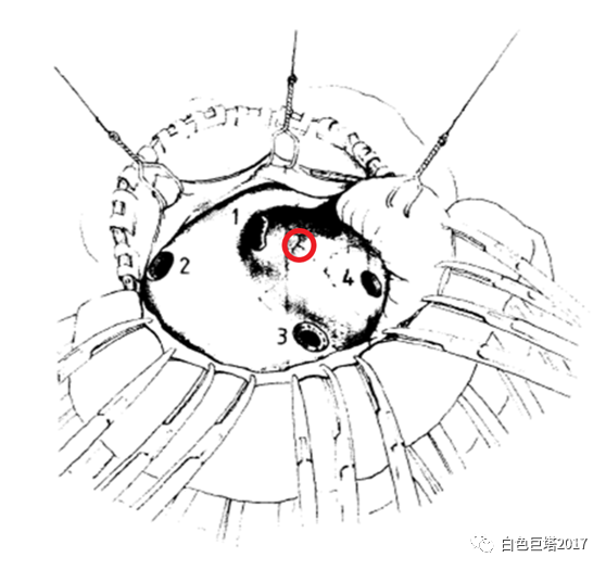 Dandy孔和MacCarty孔 - 脑医汇