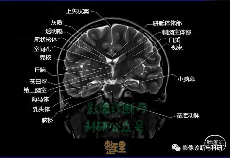全新解剖系列之二:颅脑mr冠状位 脑医汇 神外资讯 神介资讯