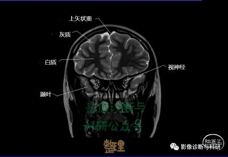 全新解剖系列之二:颅脑mr冠状位 脑医汇 神外资讯 神介资讯