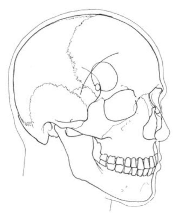 【大脑中动脉瘤夹闭术】之：额外侧入路 - 脑医汇
