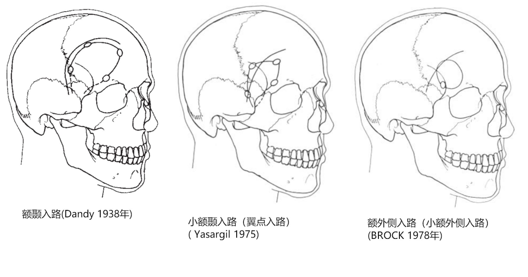【大脑中动脉瘤夹闭术】之：额外侧入路 - 脑医汇