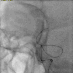 【禾锦囊】禾木Afentta™ 4F（035）抽吸导管顺利开通大脑前动脉A2段闭塞一例 - 脑医汇