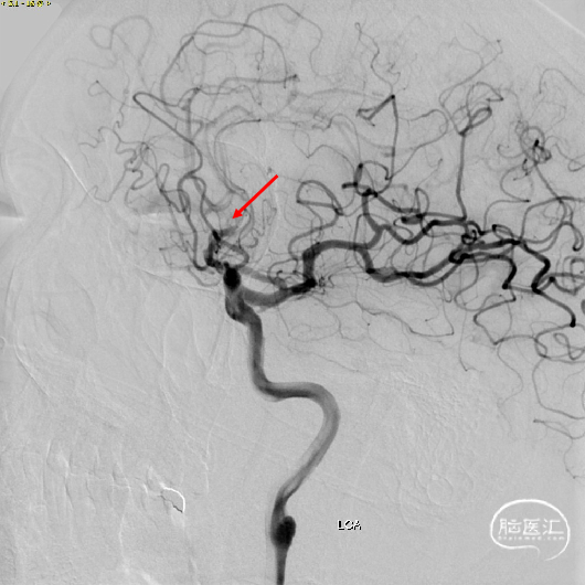 【禾锦囊】禾木Afentta™ 4F（035）抽吸导管顺利开通大脑前动脉A2段闭塞一例 - 脑医汇