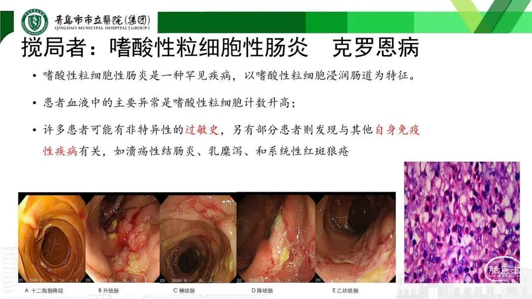监测有道丨一例嗜酸性粒细胞肠炎并克罗恩病致颅内静脉窦血栓患者的神经重症诊疗——颅脑创伤 神经重症周刊(第303期) 脑医汇