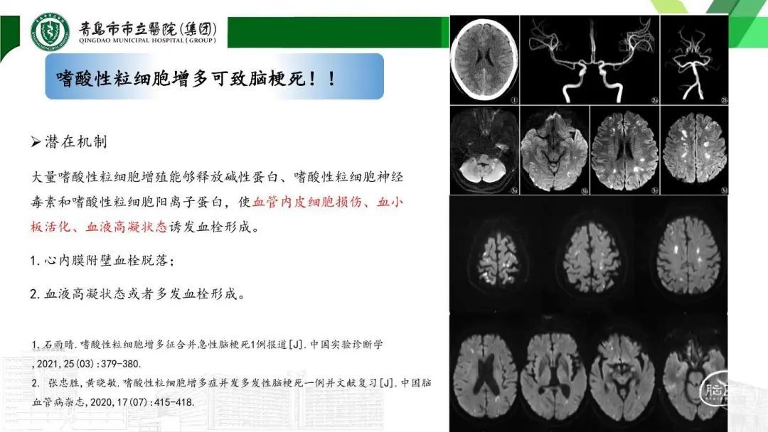监测有道丨一例嗜酸性粒细胞肠炎并克罗恩病致颅内静脉窦血栓患者的神经重症诊疗——颅脑创伤 神经重症周刊(第303期) 脑医汇