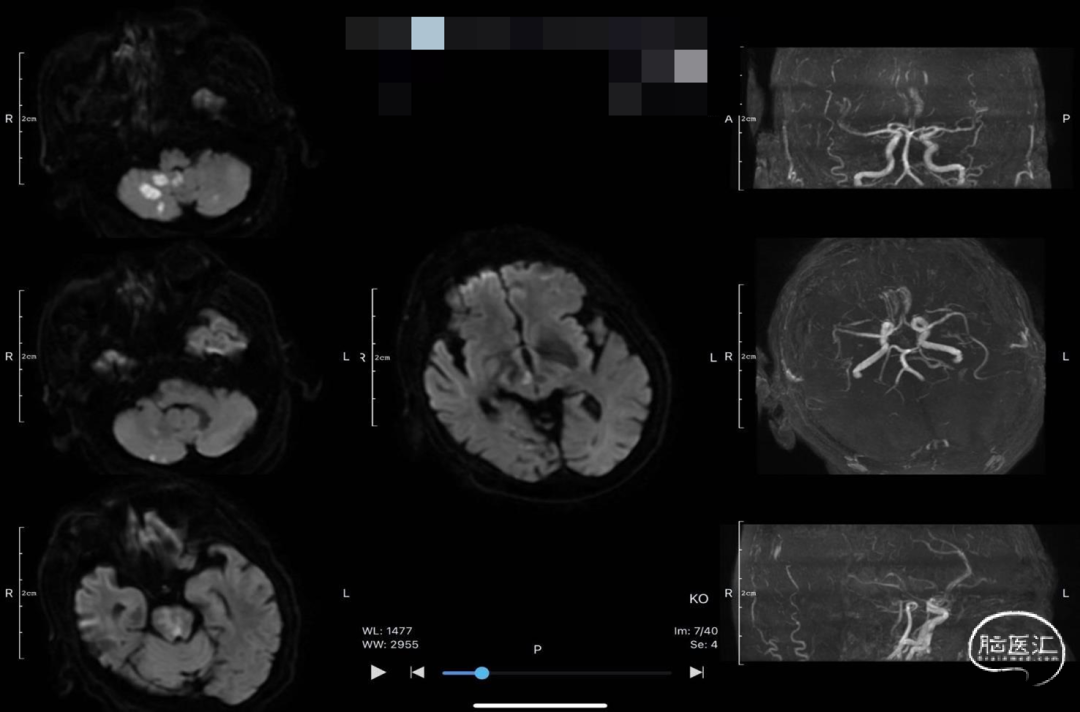 久久为功 事事专精丨Catfish®取栓支架基底动脉急性闭塞机械取栓一例 - 脑医汇