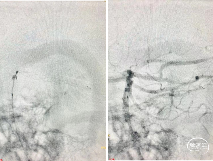 久久为功 事事专精丨Catfish®取栓支架基底动脉急性闭塞机械取栓一例 - 脑医汇