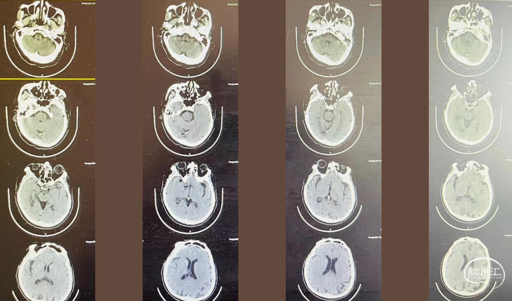 久久为功 事事专精丨Catfish®取栓支架基底动脉急性闭塞机械取栓一例 - 脑医汇