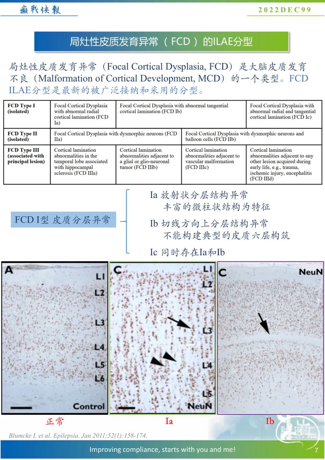 【癫战快报】第99期：右额叶局灶性皮质发育不良（FCD）癫痫手术一例 - 脑医汇 - 神外资讯 - 神介资讯
