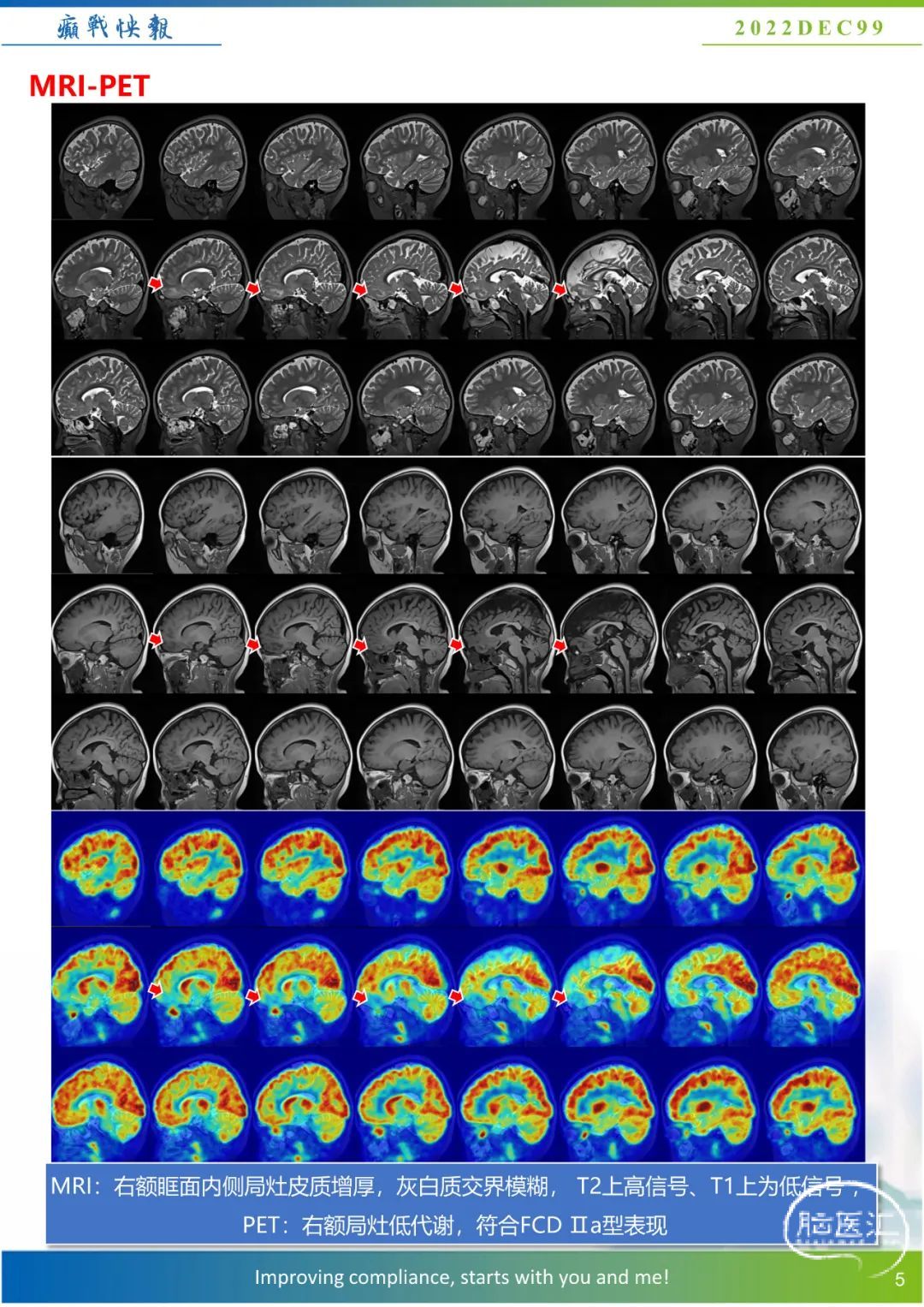 【癫战快报】第99期：右额叶局灶性皮质发育不良（FCD）癫痫手术一例 - 脑医汇 - 神外资讯 - 神介资讯