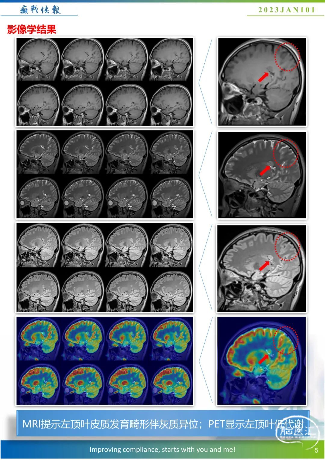 【癫战快报】第101期：SEEG联合SDE辅助治疗FCD(IIb)癫痫手术一例 - 脑医汇