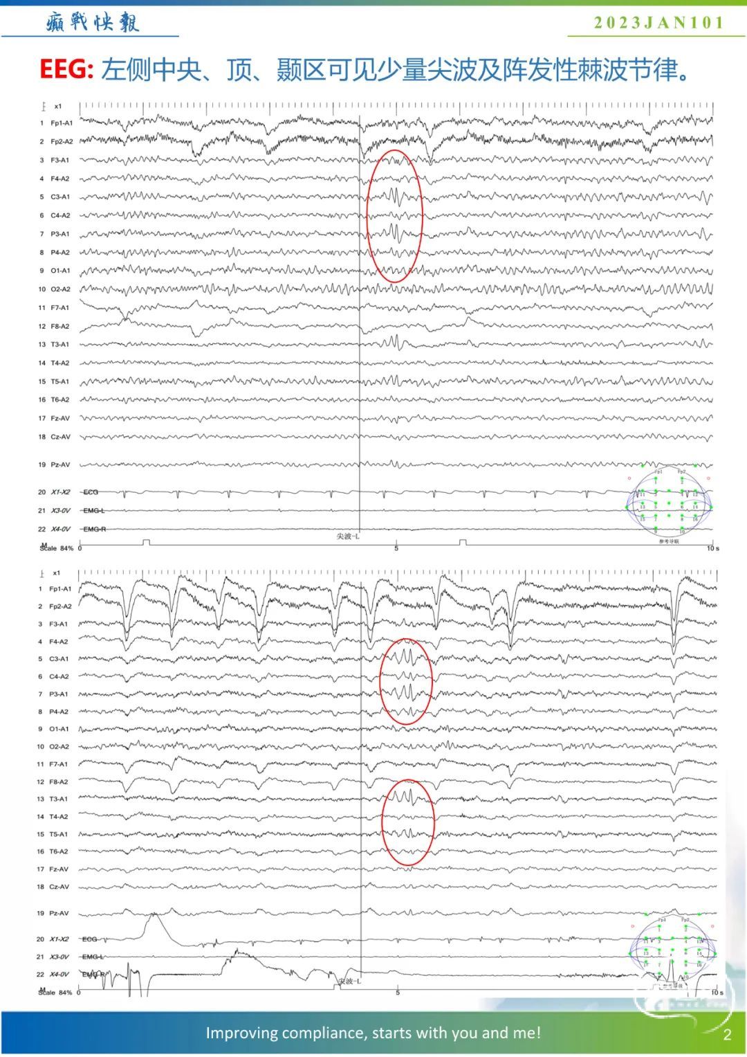 【癫战快报】第101期：SEEG联合SDE辅助治疗FCD(IIb)癫痫手术一例 - 脑医汇