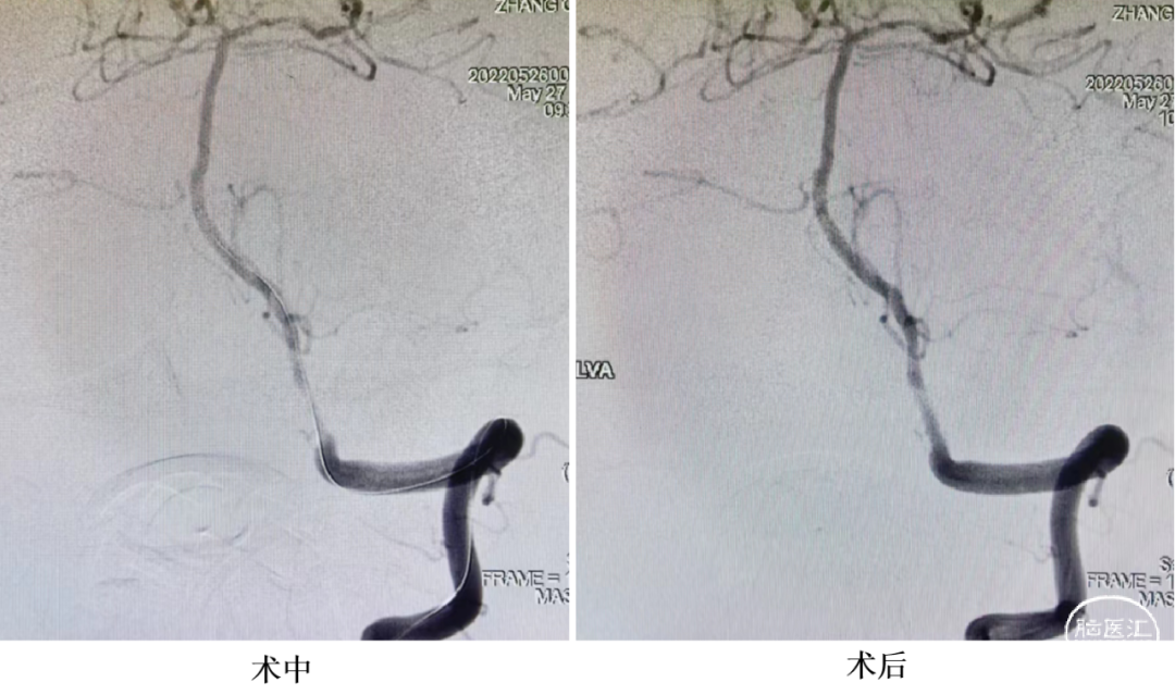 【沙场点兵 有史可鉴】经桡动脉CATALYST导管治疗颅内支架再狭窄 - 脑医汇