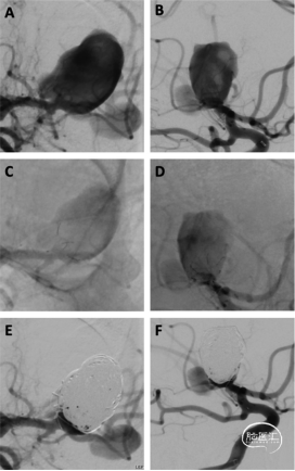【精选编译】pCONUS 2和pCONUS 2-HPC治疗宽颈颅内动脉瘤：英国多中心经验 - 脑医汇