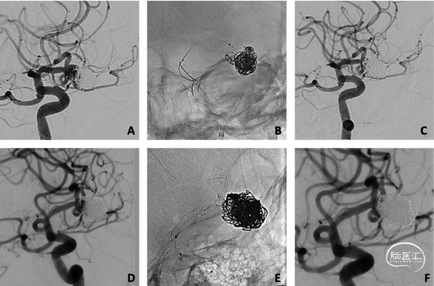 【精选编译】pCONUS 2和pCONUS 2-HPC治疗宽颈颅内动脉瘤：英国多中心经验 - 脑医汇