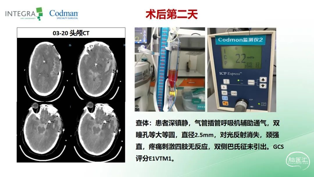 【精彩回顾】2022 凝神聚例 监测有道”isti脑创伤和脑重症病例大赛优秀作品展示（四） 脑医汇