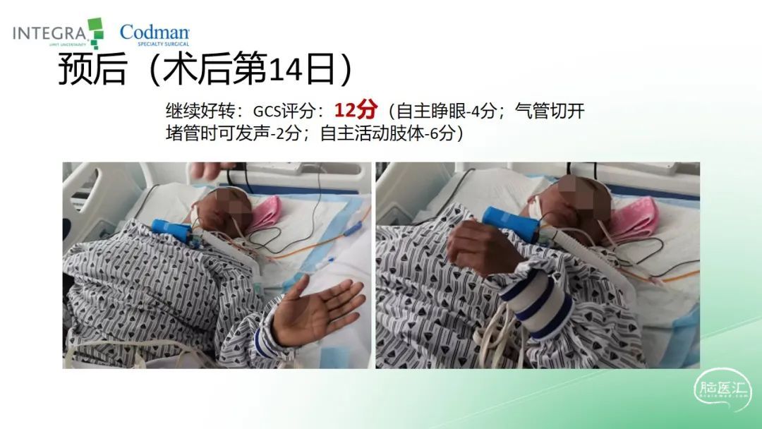 【精彩回顾】2022 凝神聚例 监测有道”isti脑创伤和脑重症病例大赛优秀作品展示（八） 脑医汇