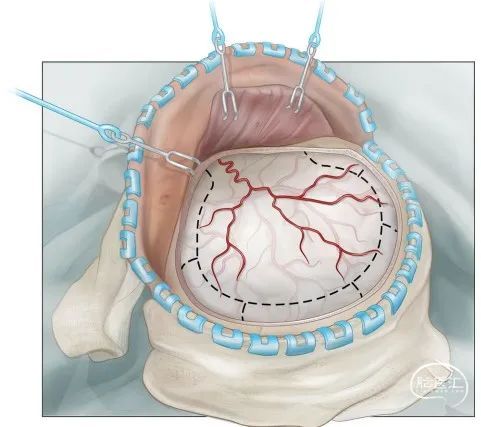后问号切口去骨瓣减压术的手术步骤 - 脑医汇