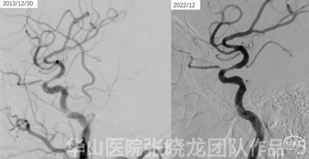 Angioplasty & Stenting of Calcified Ophthalmic Segment Stenosis - 脑医汇
