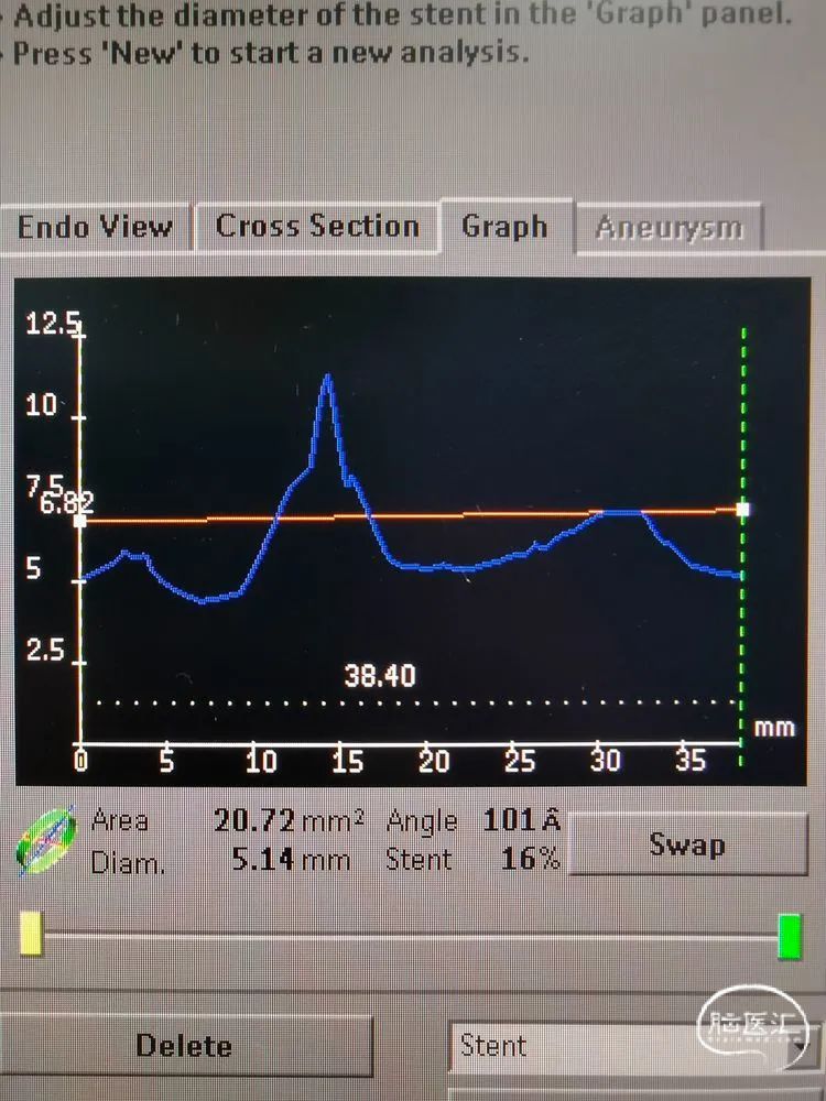 Time to Evolve 超越之旅 | 西北第二例Surpass Evolve治疗眼段大动脉瘤→修复管腔优于瘤囊栓塞 - 脑医汇