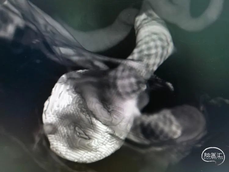 Time to Evolve 超越之旅 | 西北第二例Surpass Evolve治疗眼段大动脉瘤→修复管腔优于瘤囊栓塞 - 脑医汇