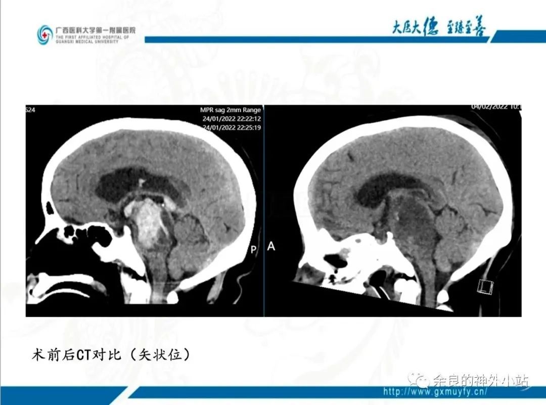 颞下入路的学习和应用 脑医汇