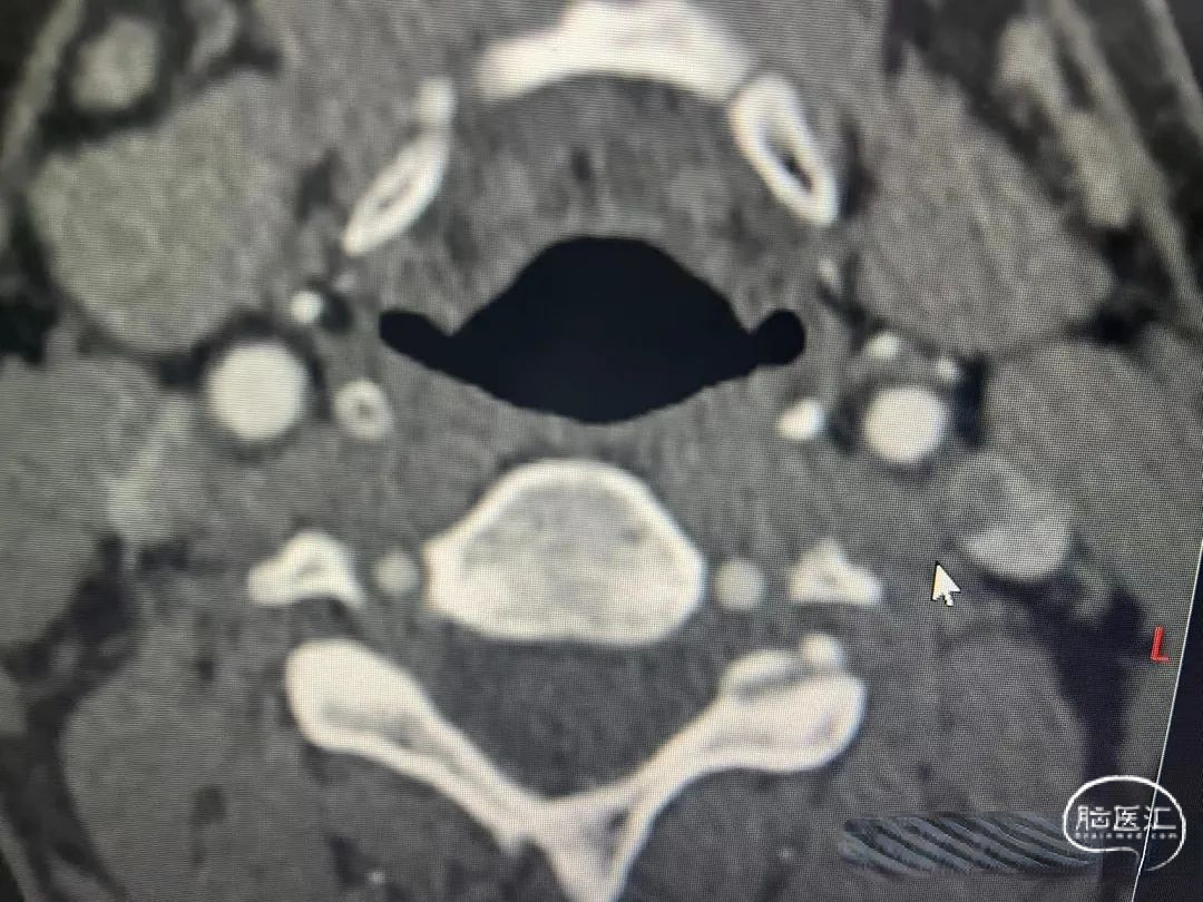 CTA的管壁成像 - 脑医汇