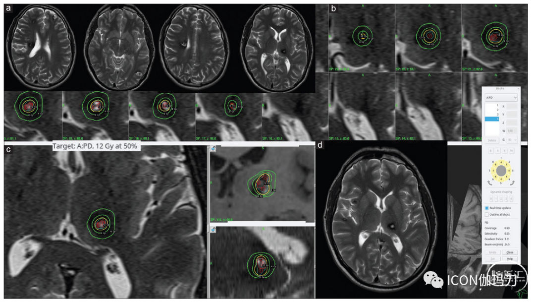 【综述】SRS治疗脑海绵状血管畸形：流言和现实 - 脑医汇