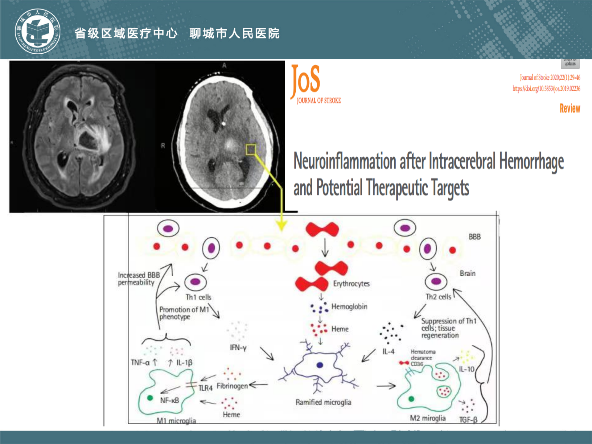 Mistie III 后时代，脑出血微创理念初步探讨 - 脑医汇 - 神外资讯 - 神介资讯