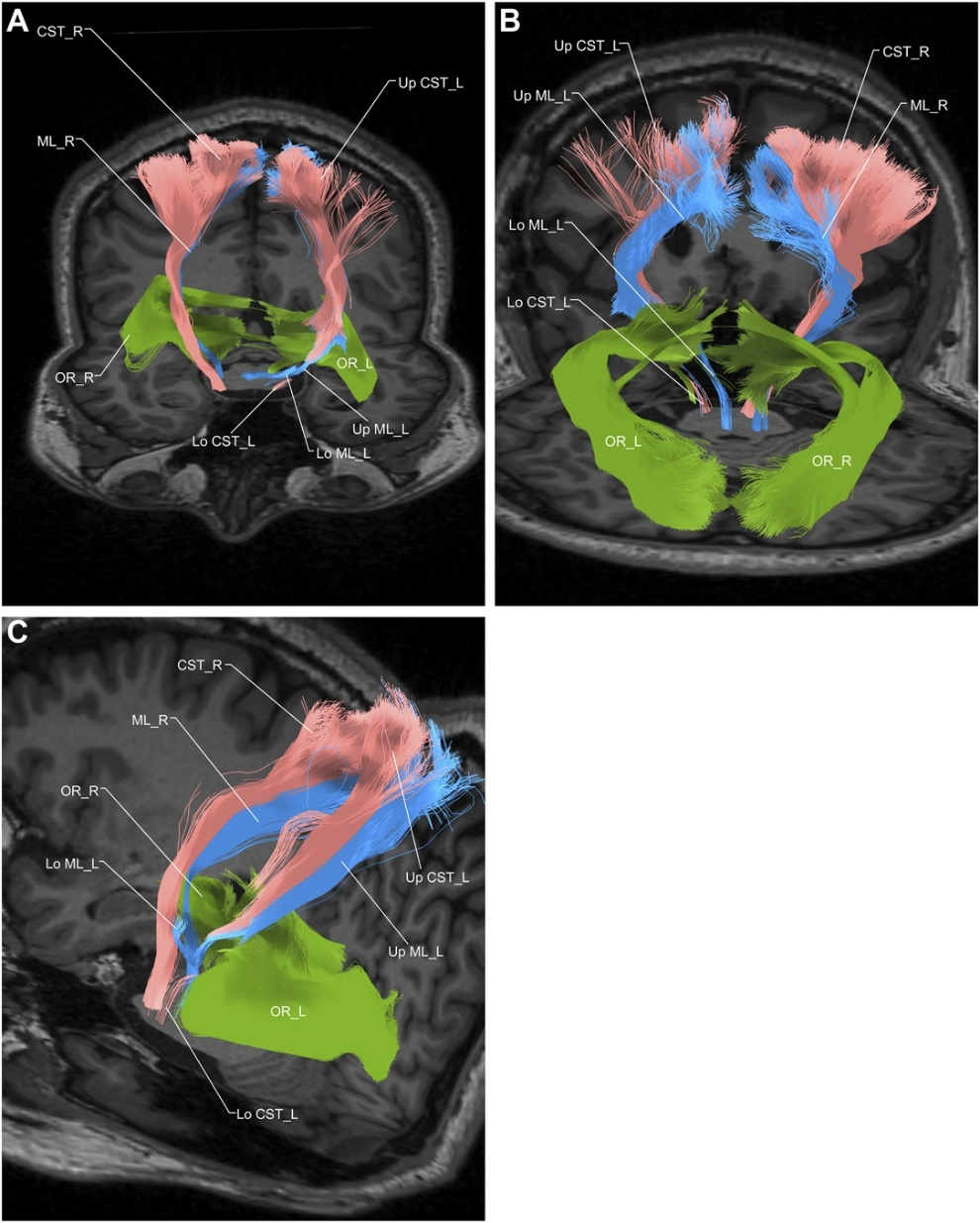 【中国声音】一种新的术式治疗跨越丘脑中脑的海绵状血管瘤（含手术视频） - 脑医汇