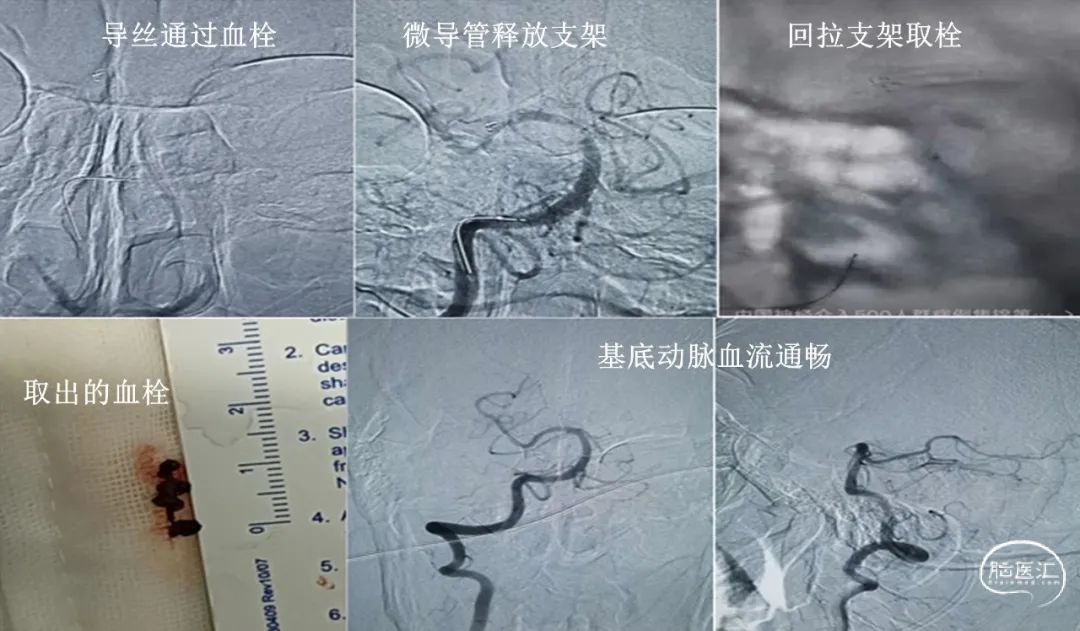 【学习整理】经桡动脉穿刺,6f导引导管支撑基底动脉取栓 脑医汇