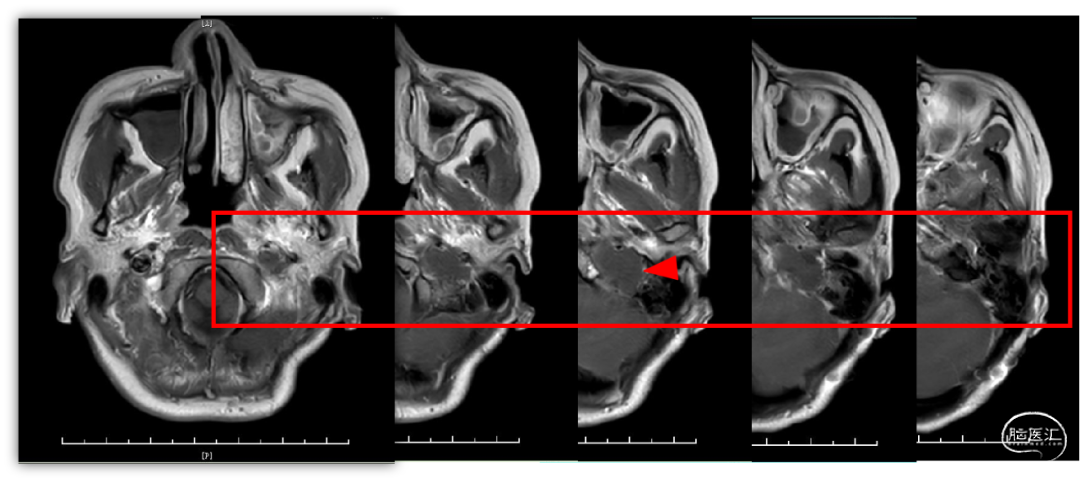 上海市第一人民医院神外薛亚军团队：耳后经颞骨迷路下入路切除颈静脉孔区复发神经鞘瘤 - 脑医汇
