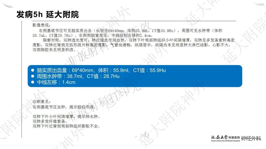 监测有道丨电磁导航引导下大量脑出血神经内镜下血肿清除术——颅脑创伤 神经重症周刊(第316期) 脑医汇