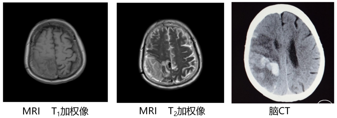 脑梗死常见临床类型特点及诊断标准 脑医汇