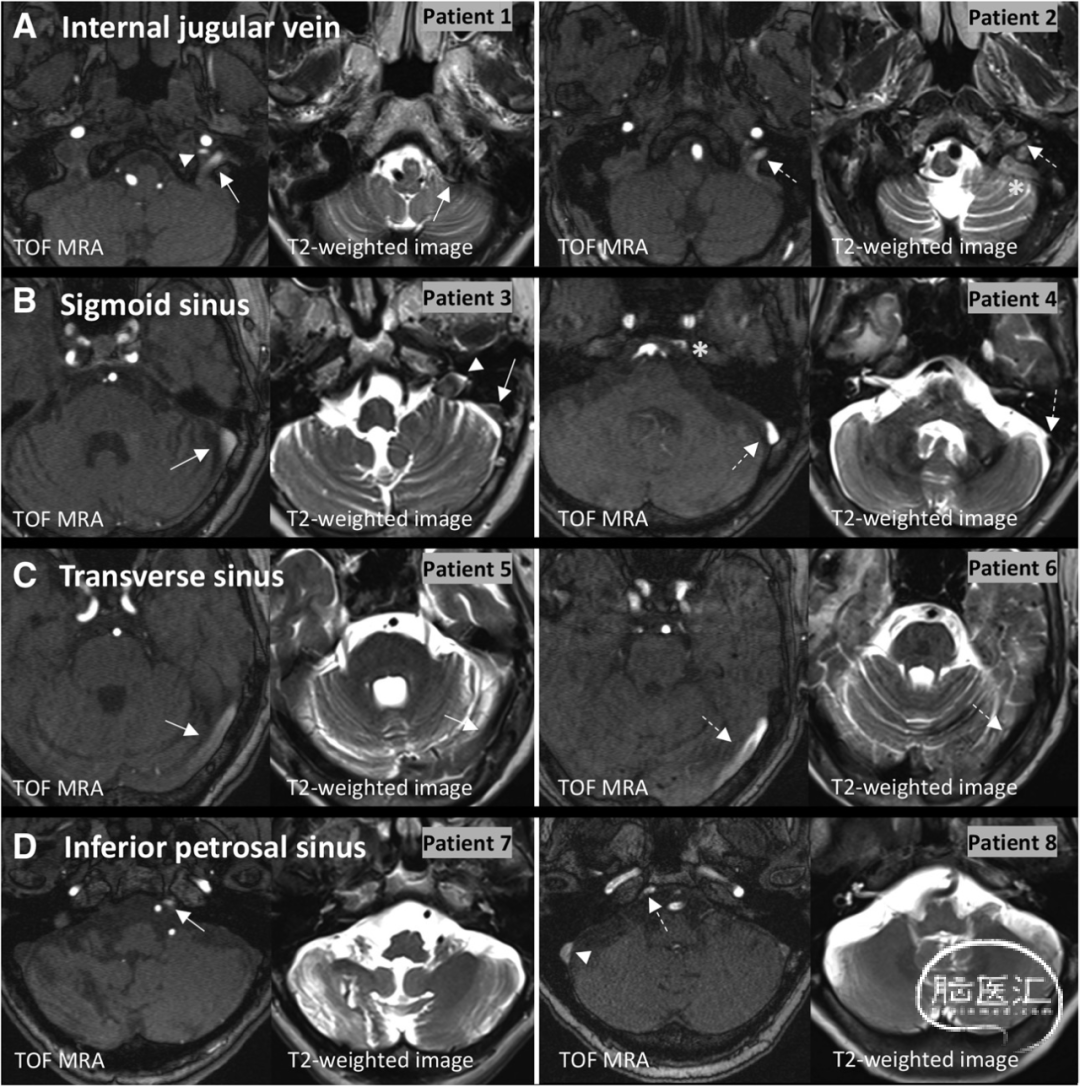 Stroke：脑静脉返流与小血管病 - 脑医汇
