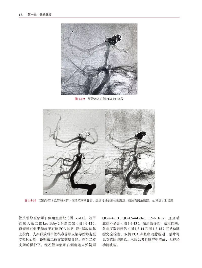【好书推荐】《基于临床病例的介入神经放射学 》江裕华教授主编,李佑祥、缪中荣教授主审 脑医汇