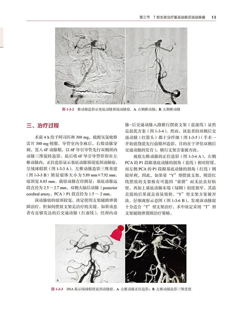 【好书推荐】《基于临床病例的介入神经放射学 》江裕华教授主编,李佑祥、缪中荣教授主审 脑医汇