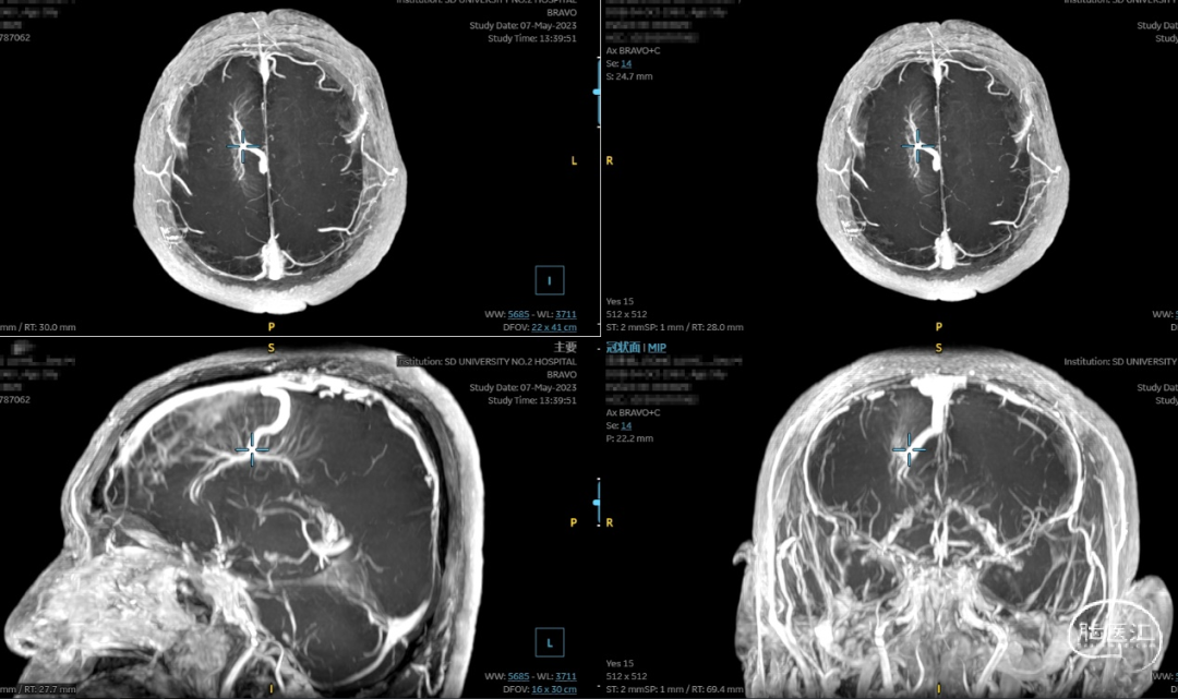 孟庆虎副主任医师：磁共振对脑静脉畸形的诊断方法 - 脑医汇