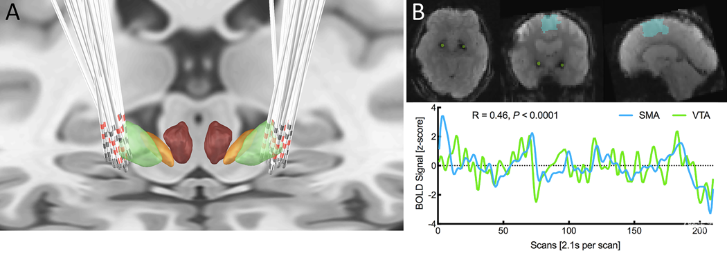 【中国声音】苍白球脑深部电刺激对帕金森病患者静息态脑功能连接的频率依赖性改变 - 脑医汇