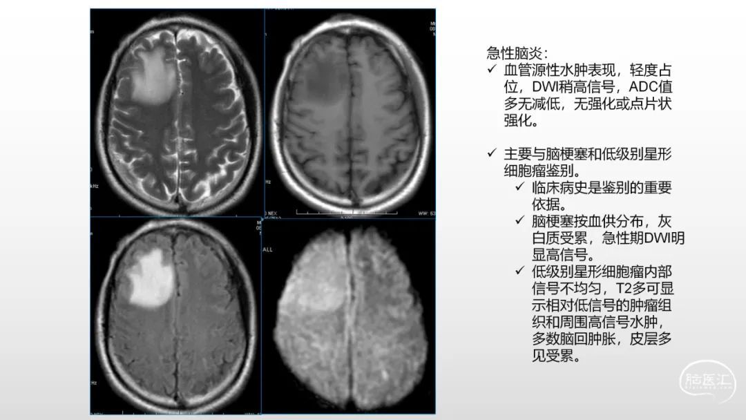 颅脑影像诊断基础知识讲座:感染和免疫性疾病1 脑医汇