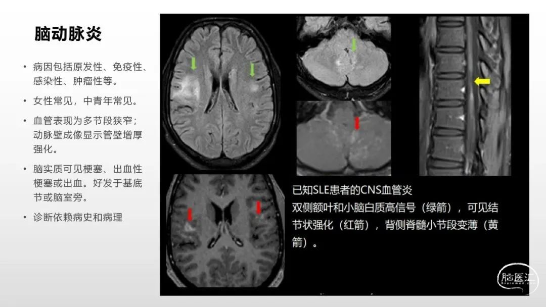 颅脑影像诊断基础知识讲座：感染和免疫性疾病2 脑医汇