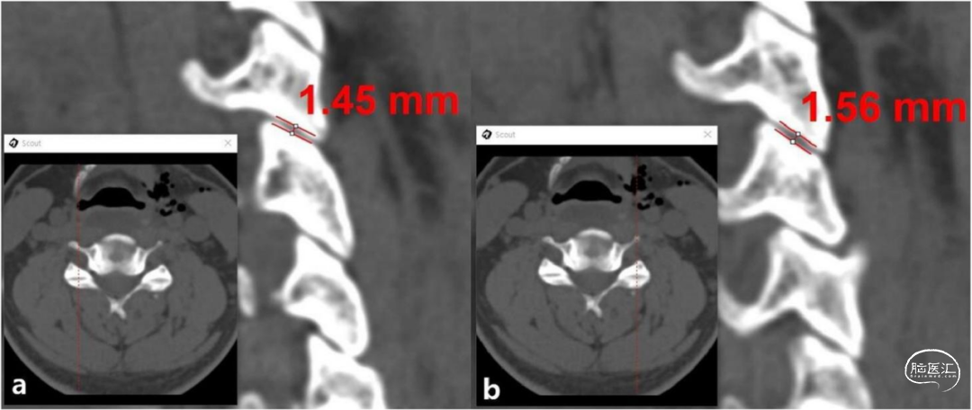 应用CT评估ACDF术后小关节牵张与临床预后的关系 - 脑医汇