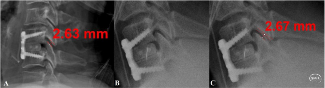 应用CT评估ACDF术后小关节牵张与临床预后的关系 - 脑医汇