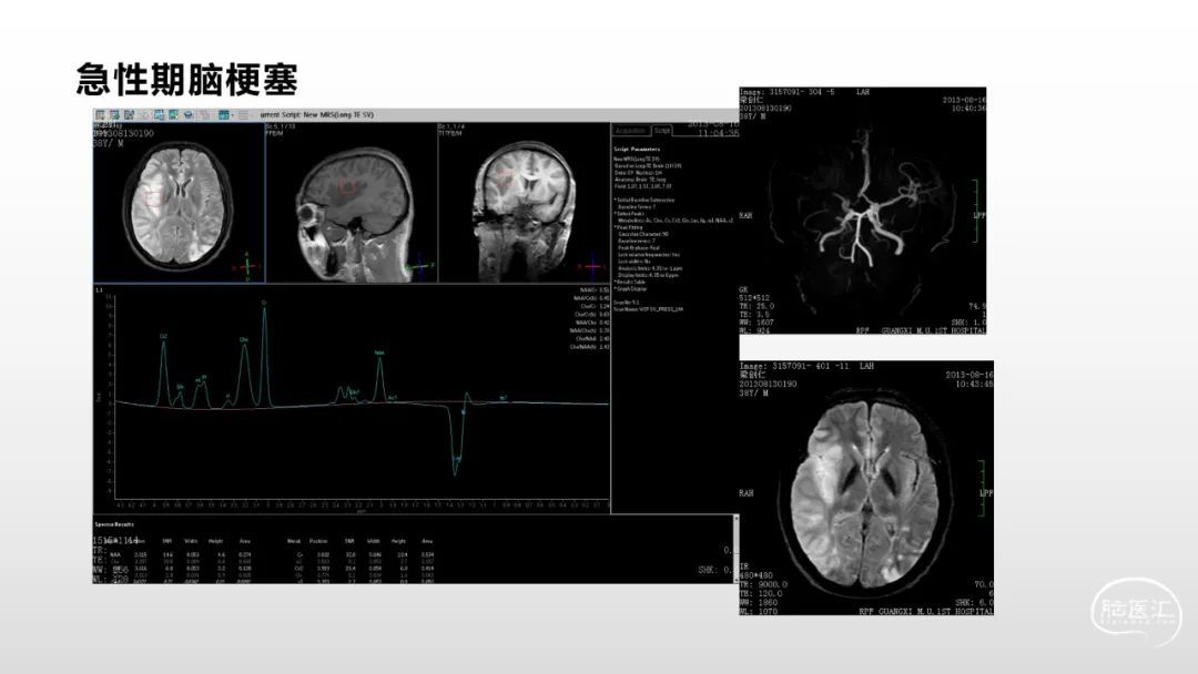 颅脑影像诊断基础知识讲座:《脑血管病》之脑小血管病和急性缺血性脑血管病 脑医汇