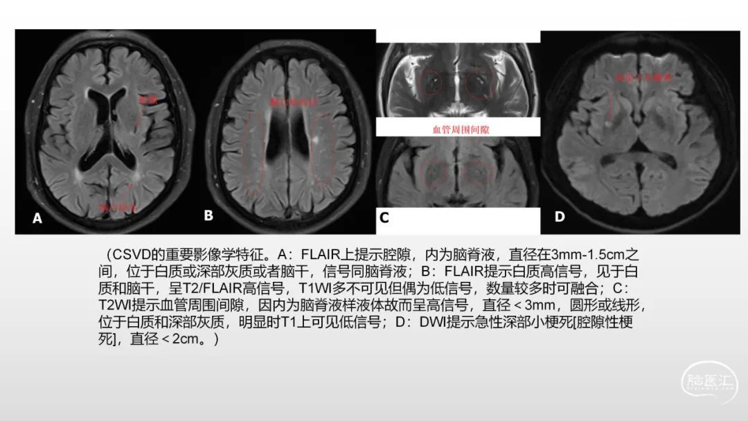 颅脑影像诊断基础知识讲座:《脑血管病》之脑小血管病和急性缺血性脑血管病 脑医汇