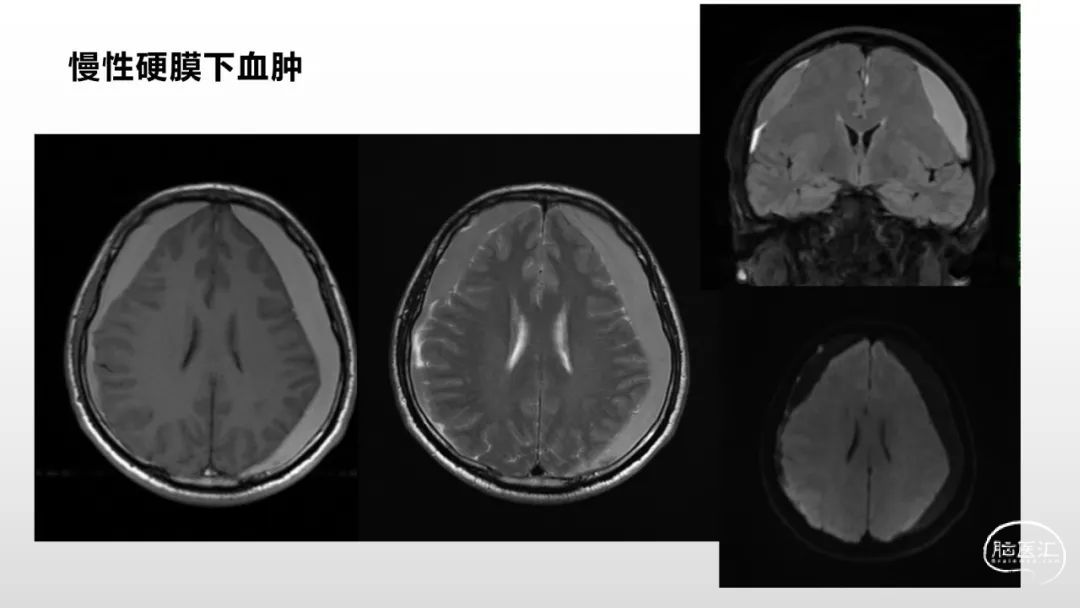 颅脑影像诊断基础知识讲座：《脑血管病》之出血、血管畸形、动脉炎及神经卡压 脑医汇 神外资讯 神介资讯